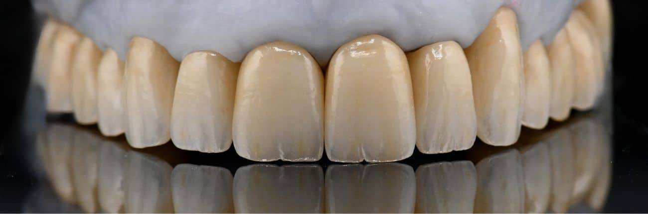 Zubni most zamjenjuje jedan ili više nedostajućih zuba | MB dent