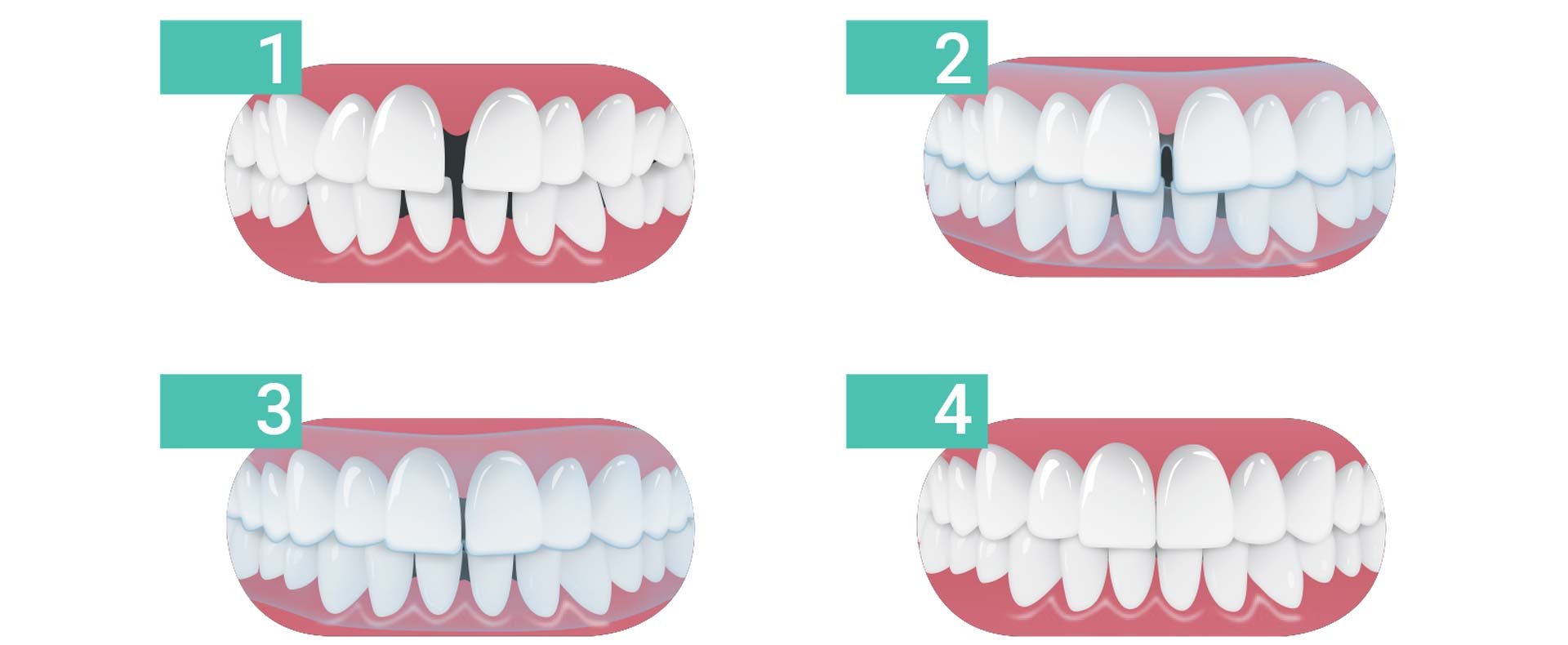 Prozirni aparatić daje rezultate već nakon nekoliko tjedana upotrebe ...